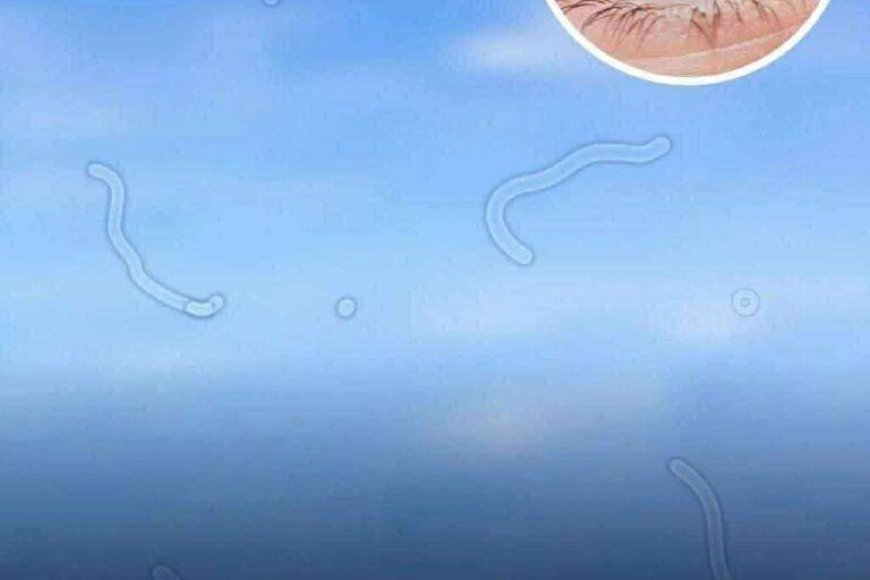 Eye floaters: what they are and what to do if you notice them ...