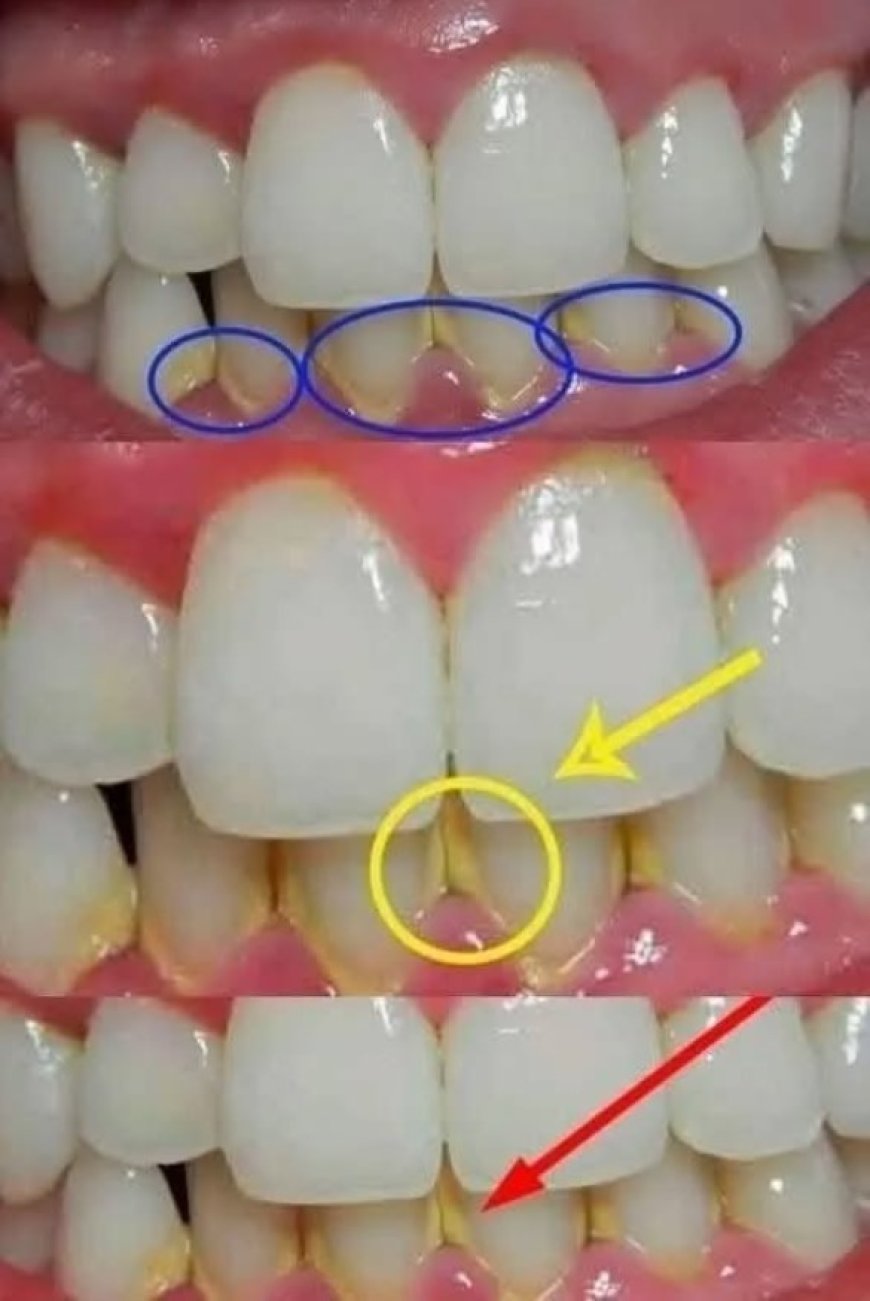 Remove dental plaque in 5 minutes naturally, without going to the ...